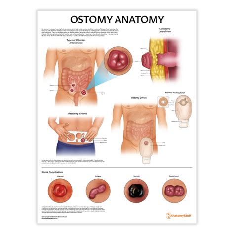 Ostomy Anatomy Poster Digestive And Urological Stoma Chart Anatomystuff