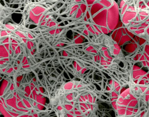 Antithrombin Iii Blood Test