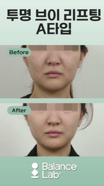 투명브이리프팅 B타입 2주차 🥰 실리프팅 실리프팅후기 실리프팅전후 리프팅 투명브이리프팅 밸런스랩성형외과 Youtube