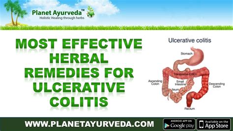 Ulcerative Colitis Diet Alternative Medicine Planet