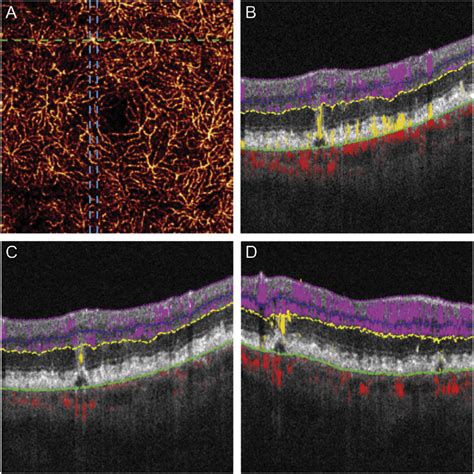 Outer Retinal Flow Detected Five Months Prior To Clinical Diagnosis Of