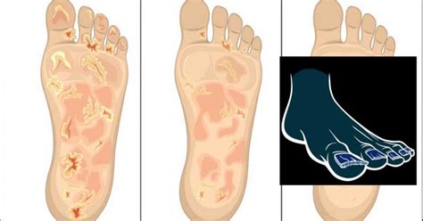 Гъбички по краката природни методи за неутрализиране на действието им