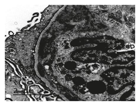 Electron Microscopy Showed Subendothelial And Mesangial Deposits A Download Scientific