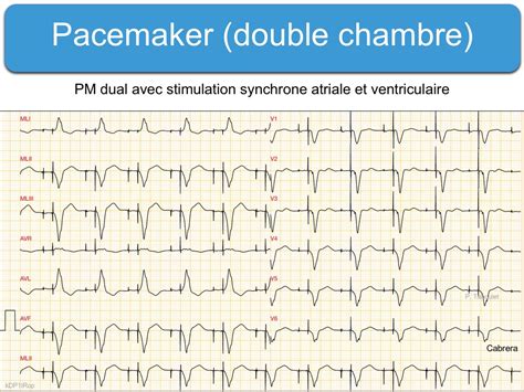 Pacemaker C Signes Ecg E Cardiogram