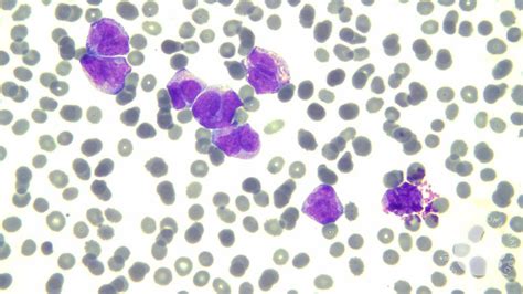 Microgranular Variant Of Apml