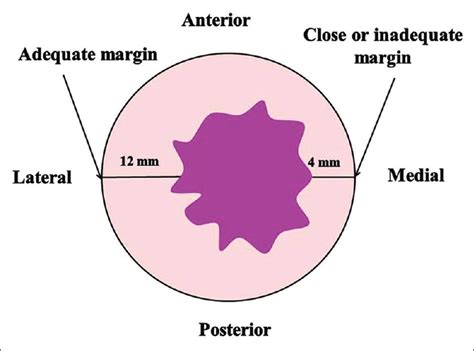 Postoperative Pathologic Assessment Of Surgical Margins In Oral Cancer