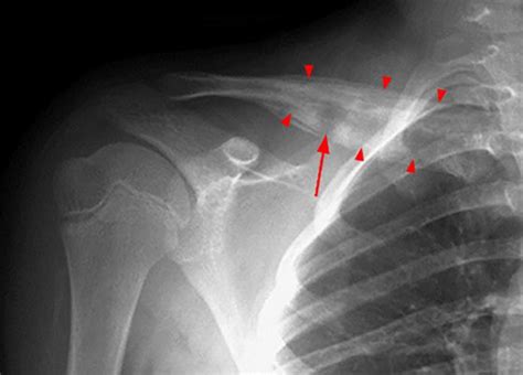 Chronic Recurrent Multifocal Osteomyelitis Radsource