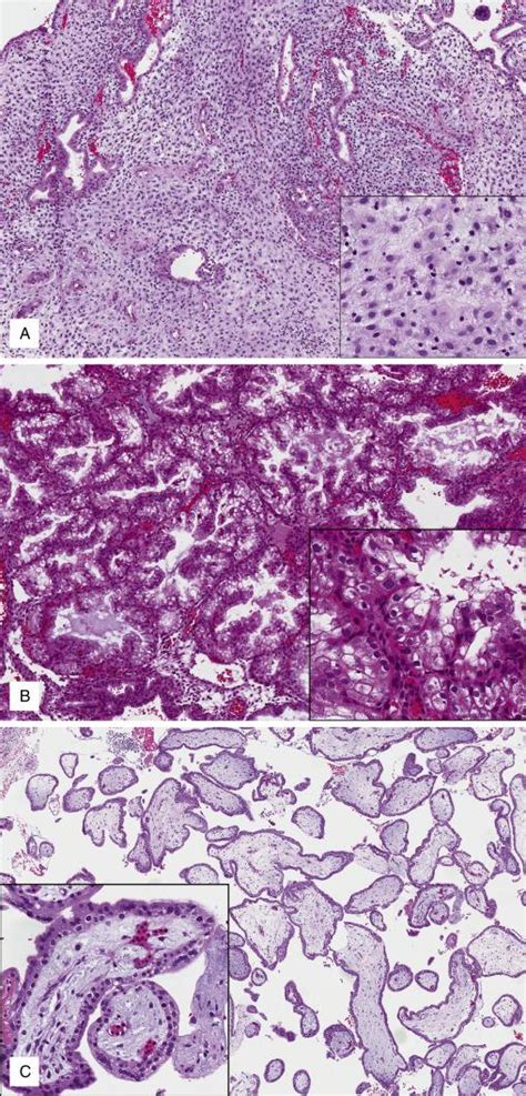 Nonneoplastic Lesions Of The Endometrium Clinical Tree