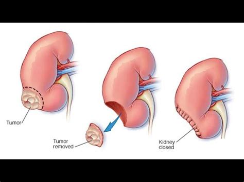 Dr Aditya Sharma Su Linkedin Lap Partial Nephrectomy For Intra Parenchymal Tumor Using