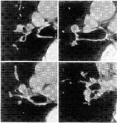 Figure 1 From A Case Of Mucosal Spreading Hilar Adenocarcinoma Of The Lung Semantic Scholar