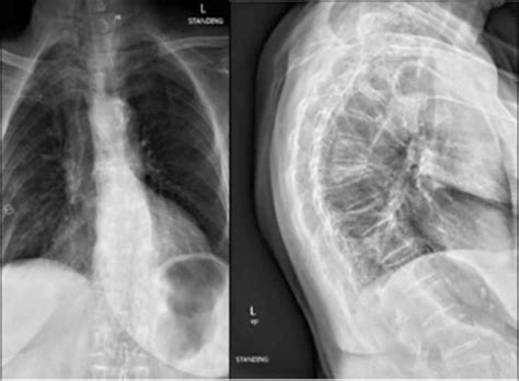 Compression Fracture X Ray