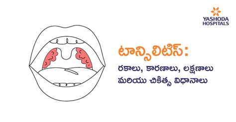 What Are Adenoids And Its Causes Symptoms Complications And Treatment
