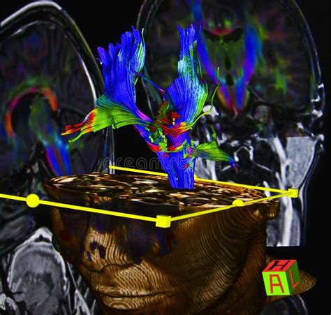 Brain Diffusion Tensor MR Imaging Stock Photo Image Of Exam Scan