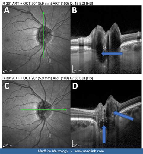 Papilledema Vs Normal