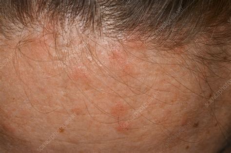 Psoriasis On A Womans Forehead Stock Image C0585532 Science
