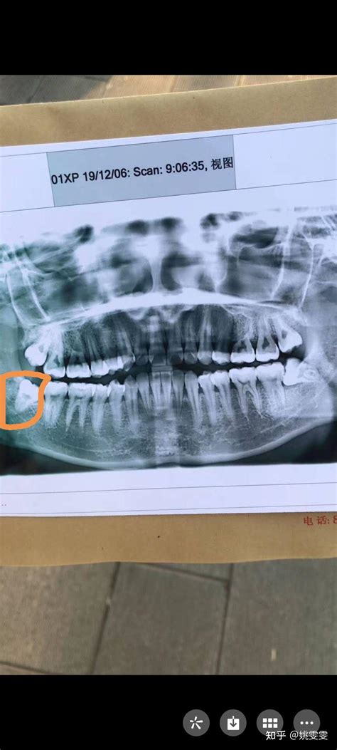 拔智齿好爽！ 知乎