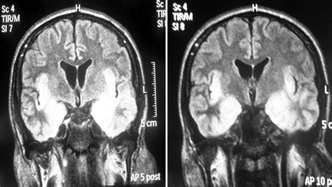 Hypersignal In Flair Acquisition On Mri In Bilateral Temporal Lobes