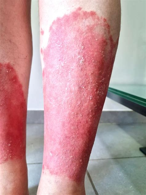 Psoriase