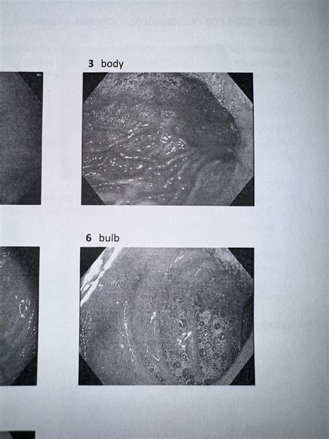 Egd Procedure Report R Medical Advice