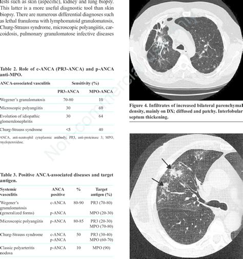 Patchy Infiltrates Download Scientific Diagram Patchy Infiltrates Download Scientific Diagram