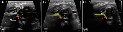 Congenital Hip Dysplasia Radiology