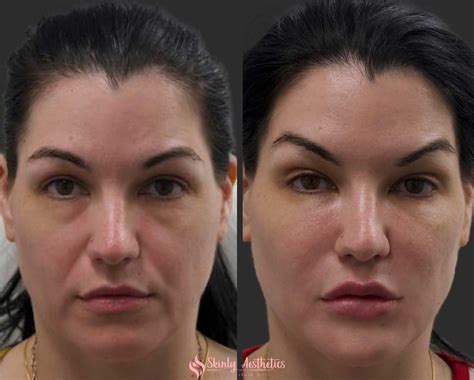 Juvederm Eyes Crescent