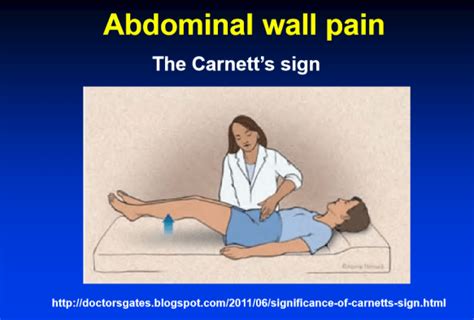 Median Arcuate Ligament Syndrome Gutsandgrowth