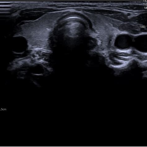Thyroid Gland Assimetry With Hypoplasia Of The Left Lobe And Structural
