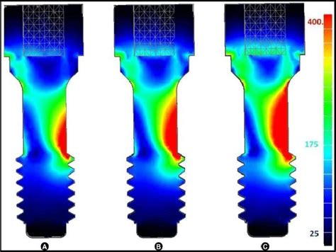 Application Of The Finite Element Method In Dentistry Implantology
