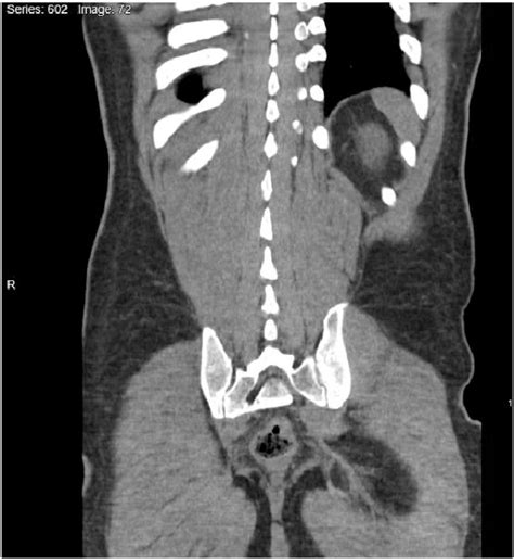 Ct Scan Showing Prostatitis With Probable Prostatic Abscess Download Scientific Diagram