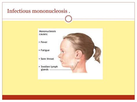 Ppt Epstein Barr Virus Ebv Powerpoint Presentation Free Download
