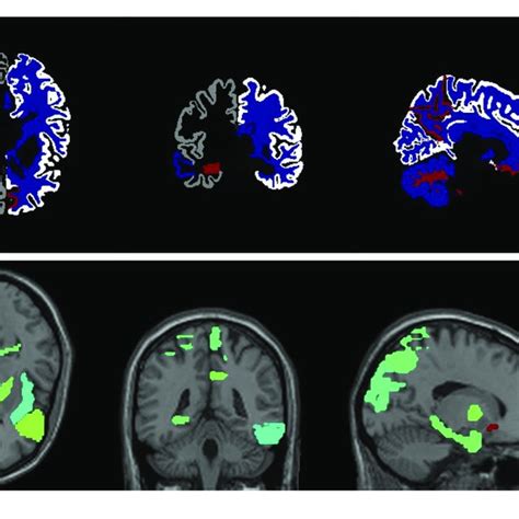 Visualization Of Top Identified Imaging Markers For Ravlt Memory