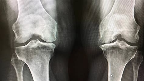 Joint Calcification Op Dr Özgür Oktay Nar