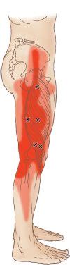 Vastus Lateralis Trigger Point Learn Muscles
