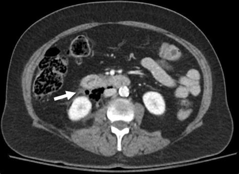 Ct Scan With Arrow Demonstrating Duodenal Wall Thickening And Download Scientific Diagram