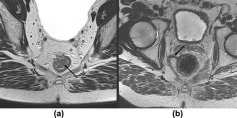 Transanal Endoscopic Microsurgery For Rectal Cancer Clinical Radiology