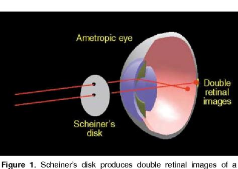 Figure 1 From Principles Of Hartmann Shack Aberrometry Semantic Scholar