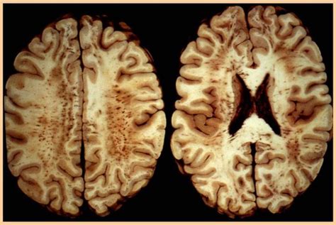 Diffuse Axonal Injury Gross