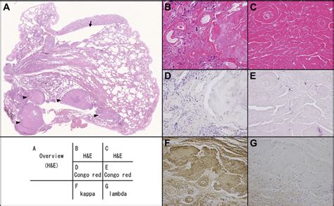 A Diffuse Deposits Of Amorphous Eosinophilic Materials In The