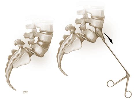 Cartoon Demonstrating L4 5 Discectomy Download Scientific Diagram