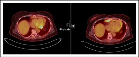Table 2 From Refinement Of The Lugano Classification Lymphoma Response Criteria In The Era Of