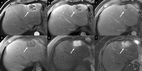 A Surgically Proven Combined Hepatocellular Cholangiocarcinoma In A Download Scientific Diagram