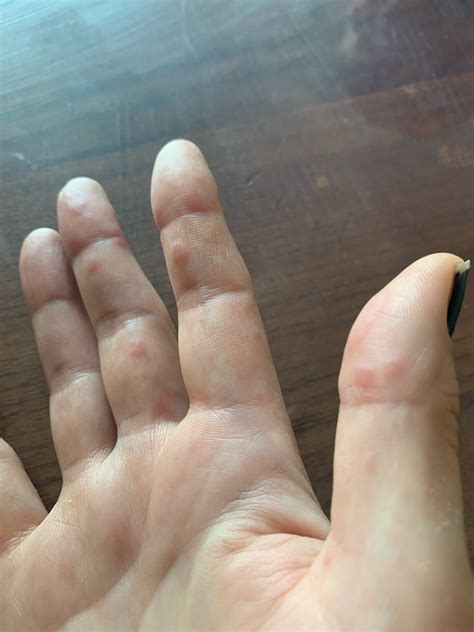 8 Common Types Of Rashes Artofit