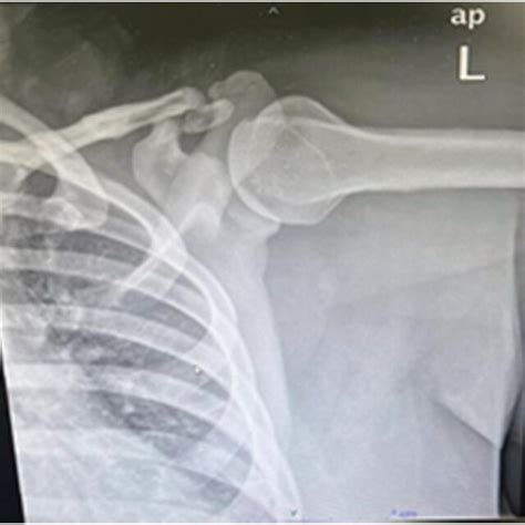 Base Of Coracoid Process Fracture With Acromioclavicular Dislocation In Hot Sex Picture