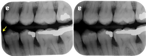 Molar Bitewing Radiograph Dr Gs Toothpix