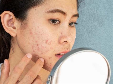 Everything To Know About Cystic Acne And How To Treat It