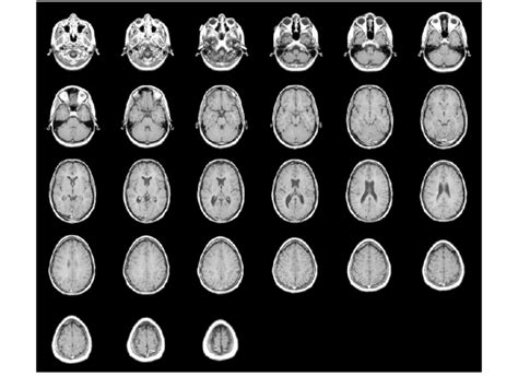Pemrograman Matlab Untuk Pengolahan Citra Medis Visualisasi 3d Citra Kepala Mri Pemrograman