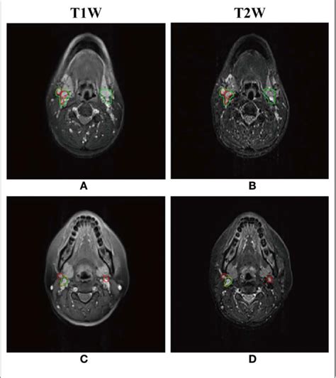 Figure 1 From Fully Automated Segmentation Of Nasopharyngeal Carcinoma On Dual Sequence Mri