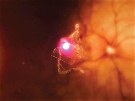 A Laser Treatment Approach To Floaters Insight