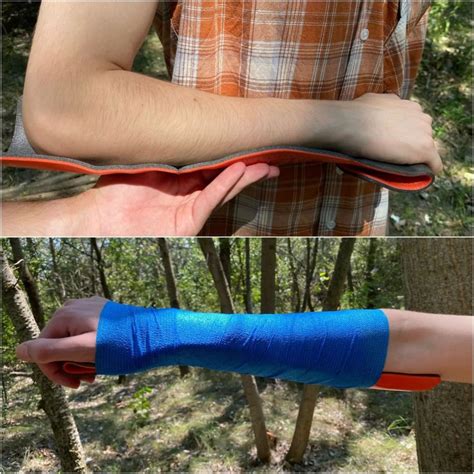 Splinting Upper Limb Fractures Using A Splint Kit Rhinorescue